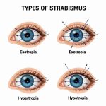 Strabismus: Mengenal Gejala dan Penanganan Mata Juling | INCA Hospital