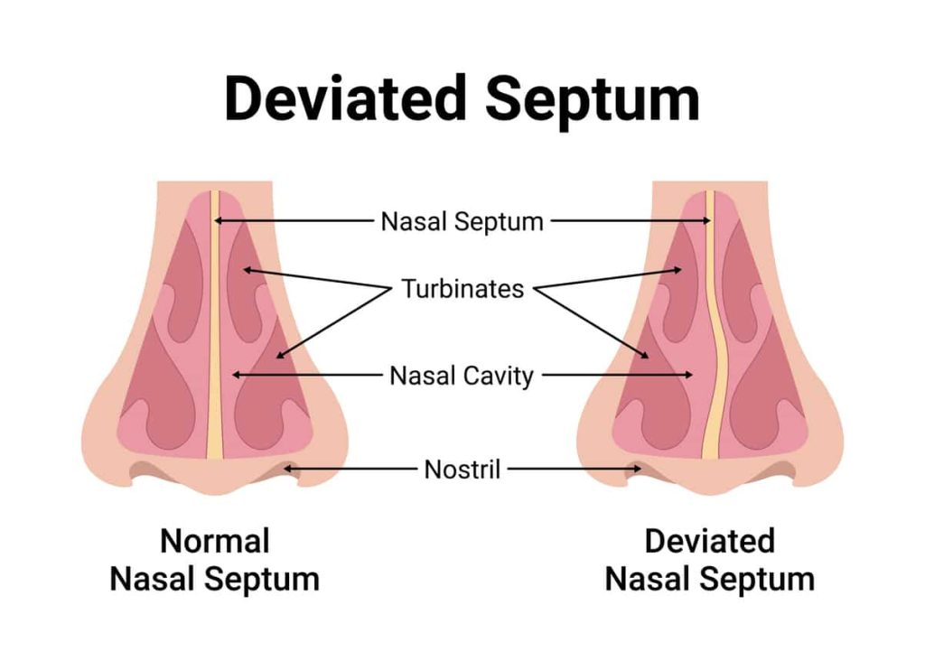 Deviasi Septum dan Dampaknya terhadap Kesehatan Pernapasan
