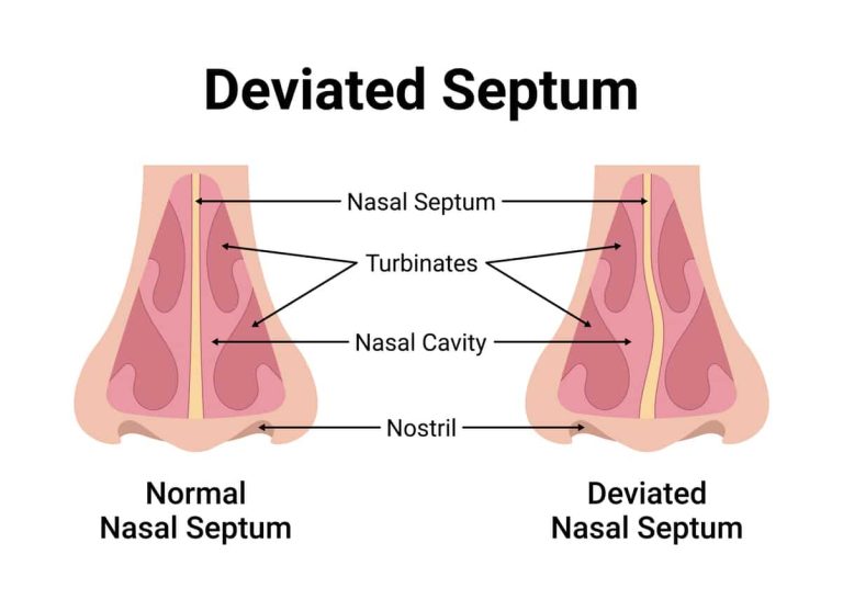 Deviasi Septum dan Dampaknya terhadap Kesehatan Pernapasan